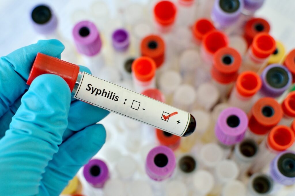 How Long Does It Take for Syphilis to Show Up? Complete Timeline ...